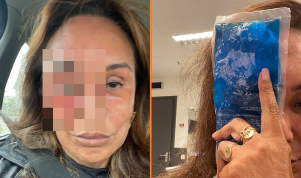 Patty Brard deelt schokkende foto van gezicht dat volledig in de ... Patty Brard deelt schokkende foto van gezicht dat volledig in de ...